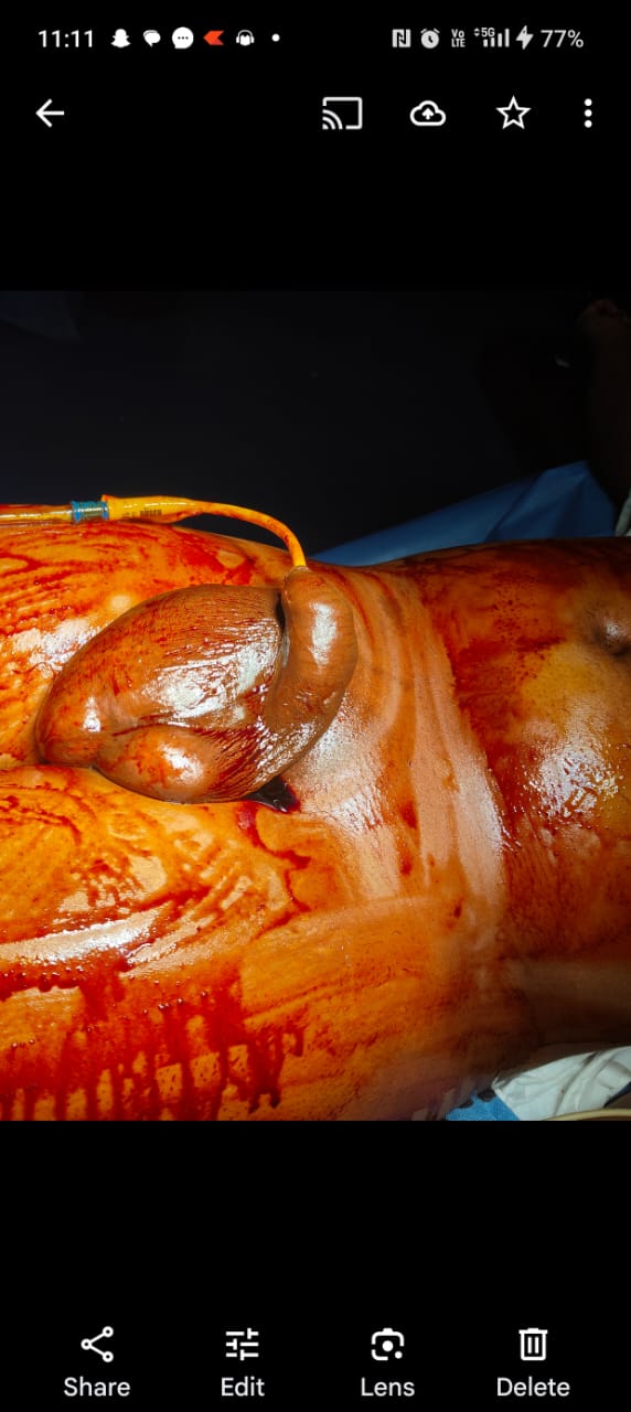 Large Right Inguinal Hernia: Successful Laparoscopic Repair