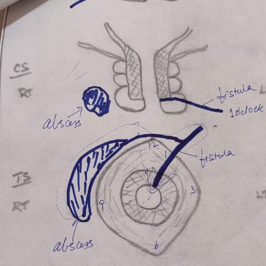 Effective Treatment for Complex Fistulas by Dr. Nayar